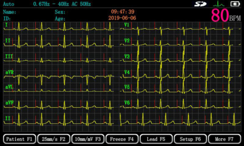 ECGMAC EM-1201 Digital 12 Channel ECG Machine – HMGDirect